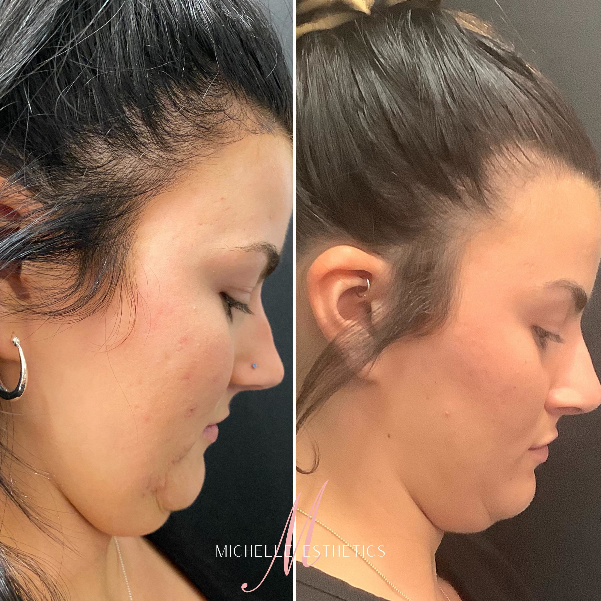 Mesotherapy - Michelle Esthetics